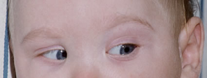 Scheelzien (strabismus, strabisme) | Gezondheidsnet
