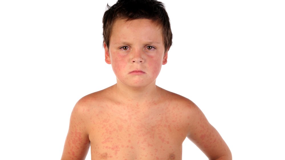 15 patiënten met mazelen in Den Haag | Gezondheidsnet