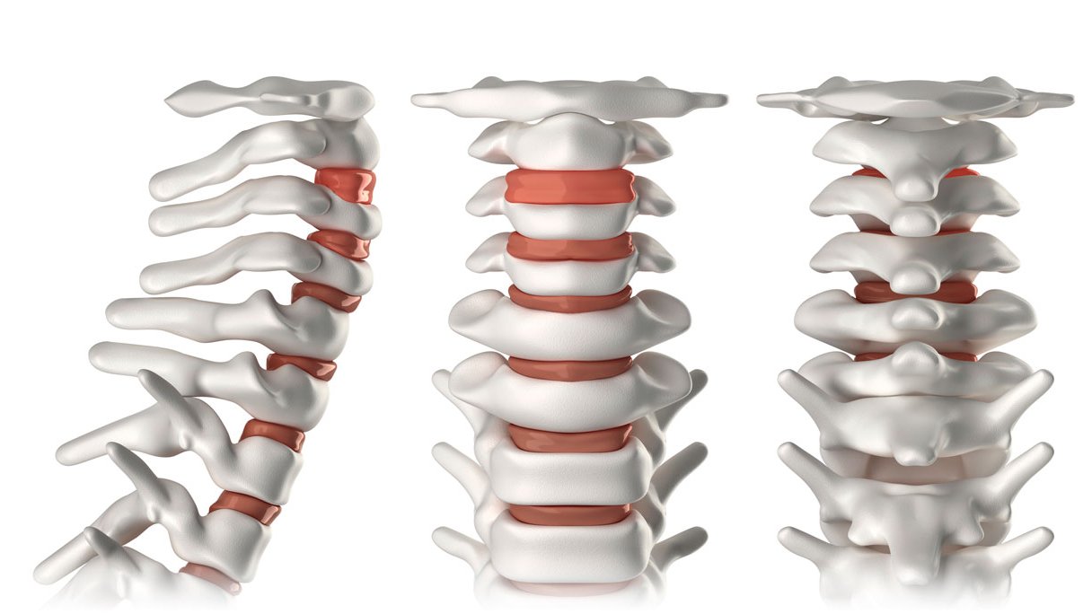 Een gescheurde wervelschijf: wat betekent dat? | Gezondheidsnet