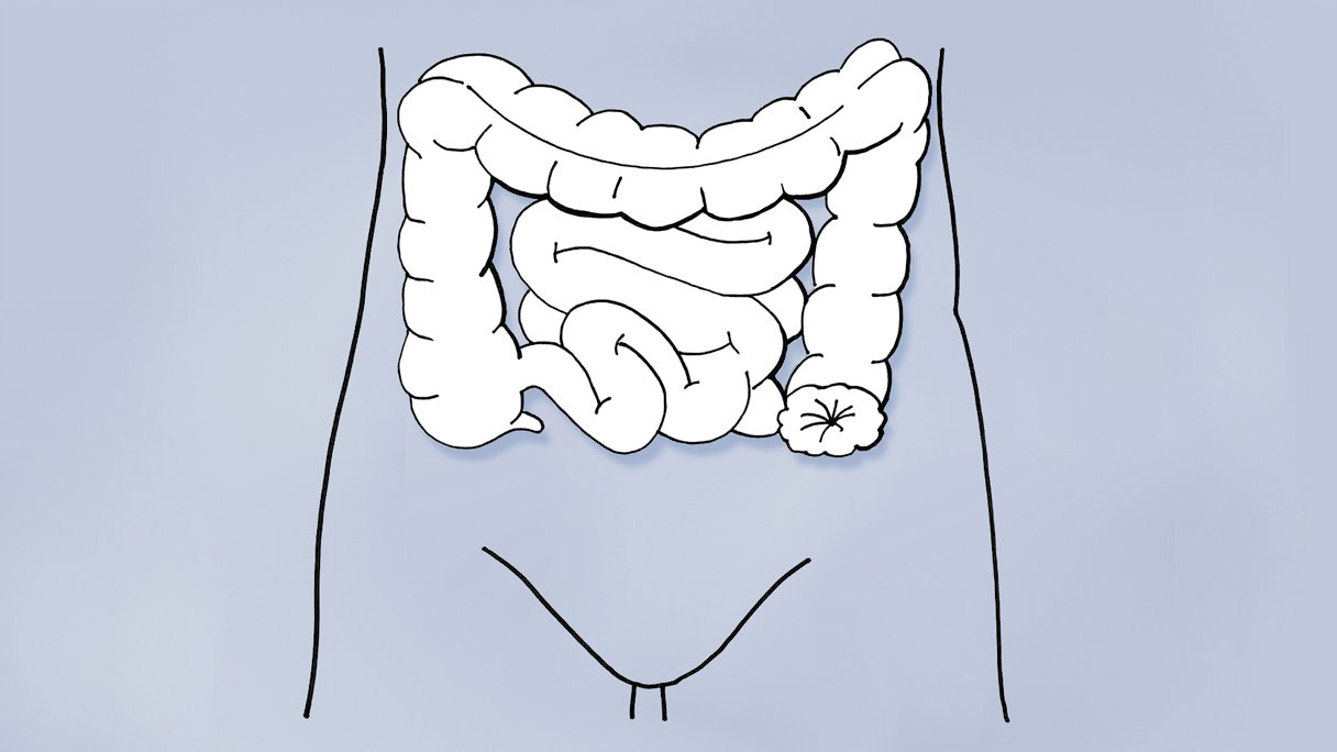 Wat is een colostoma? | Gezondheidsnet
