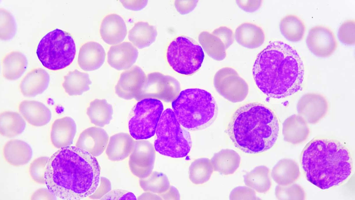 Chronische Myeloide Leukemie (CML) | Gezondheidsnet