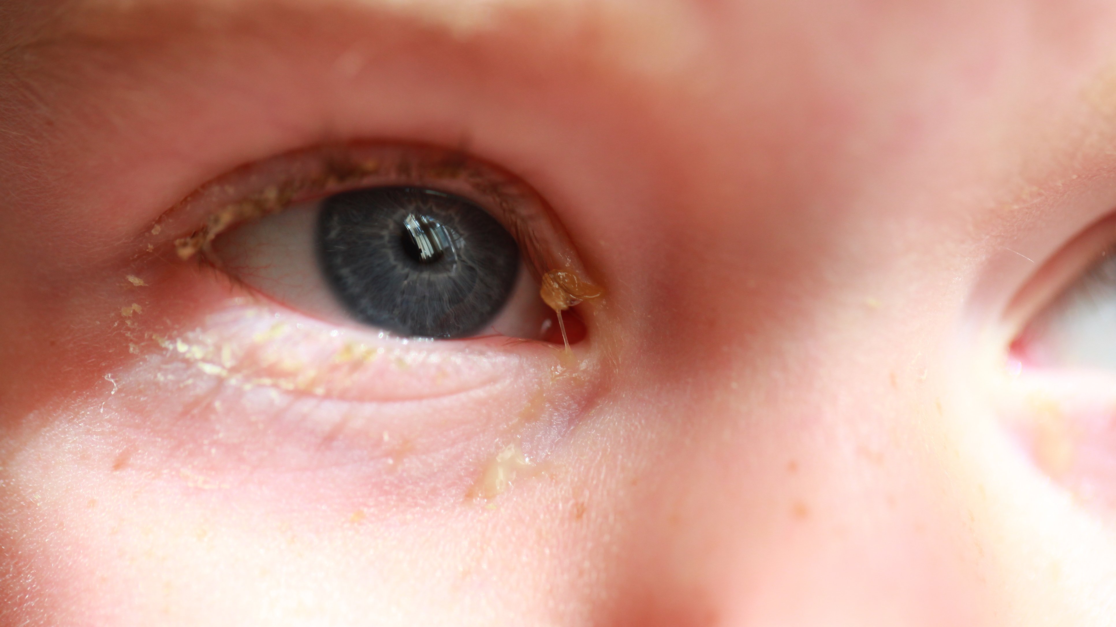 Dit zijn de oorzaken van oogontsteking | Gezondheidsnet