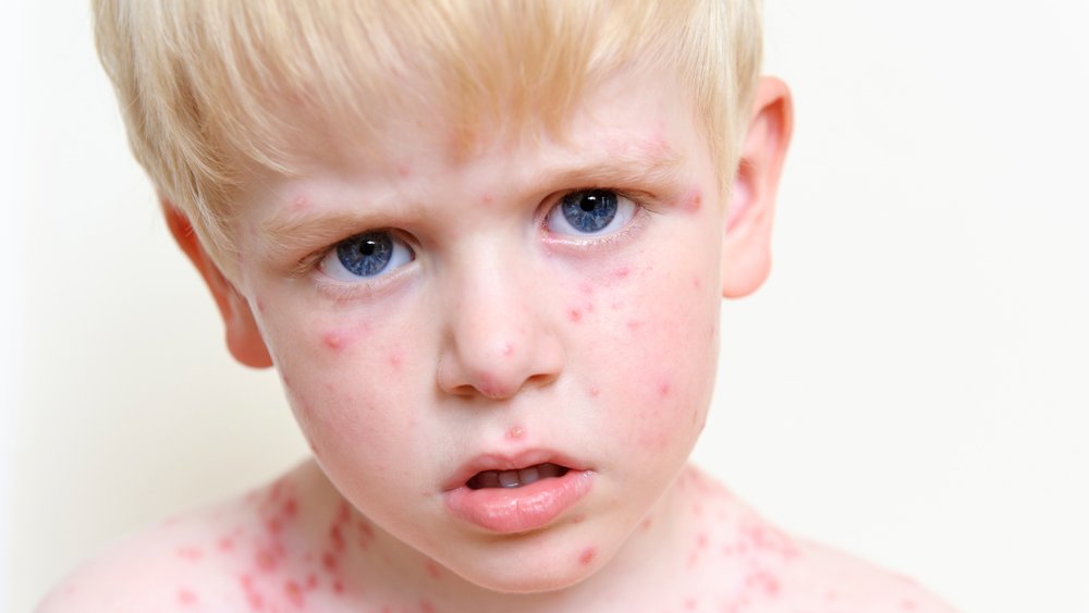 Waterpokken besmettelijk? | Gezondheidsnet