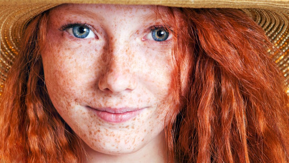 Iedereen heeft sproeten | Gezondheidsnet