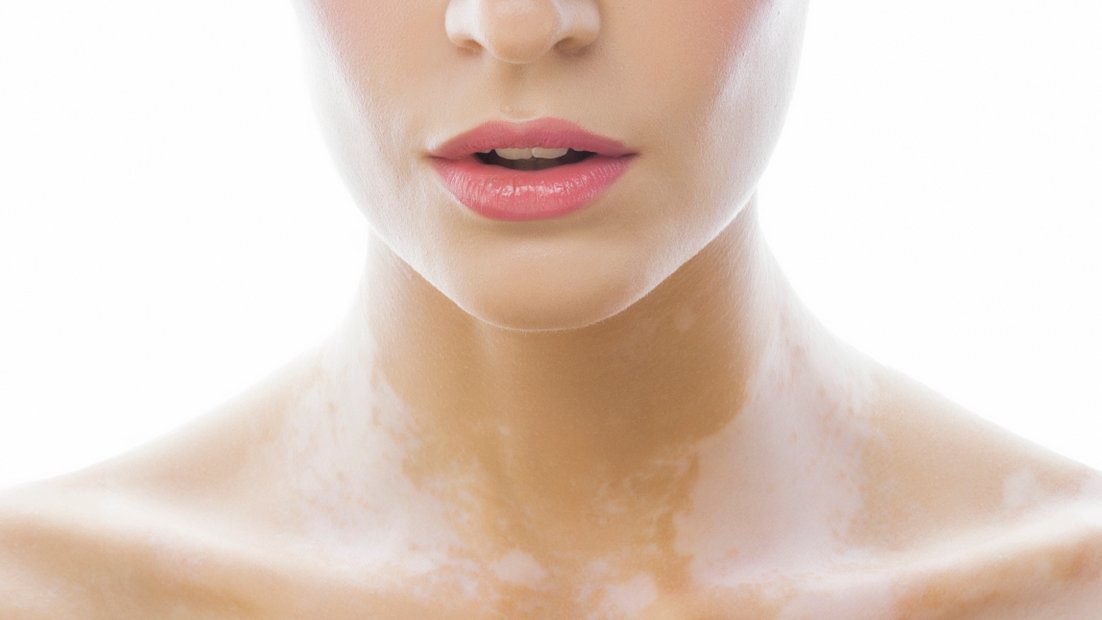 Vitiligo: witte vlekken op je huid | Gezondheidsnet